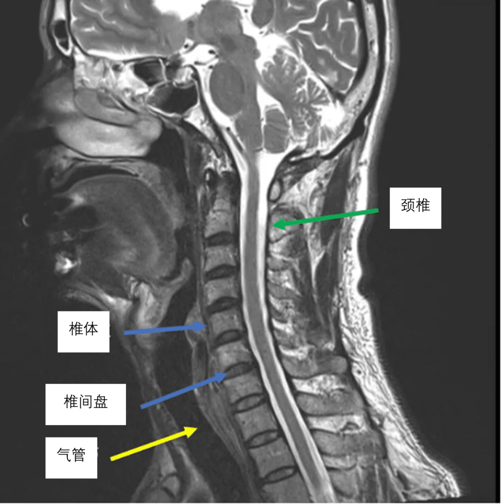 如何读取颈椎的MRI | ILC国际腰椎医院